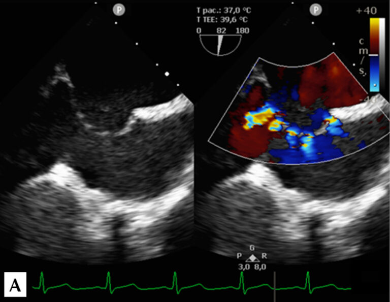 Percutaneous Closure of Multiple Atrial Septal Defects with Hemodynamic ...