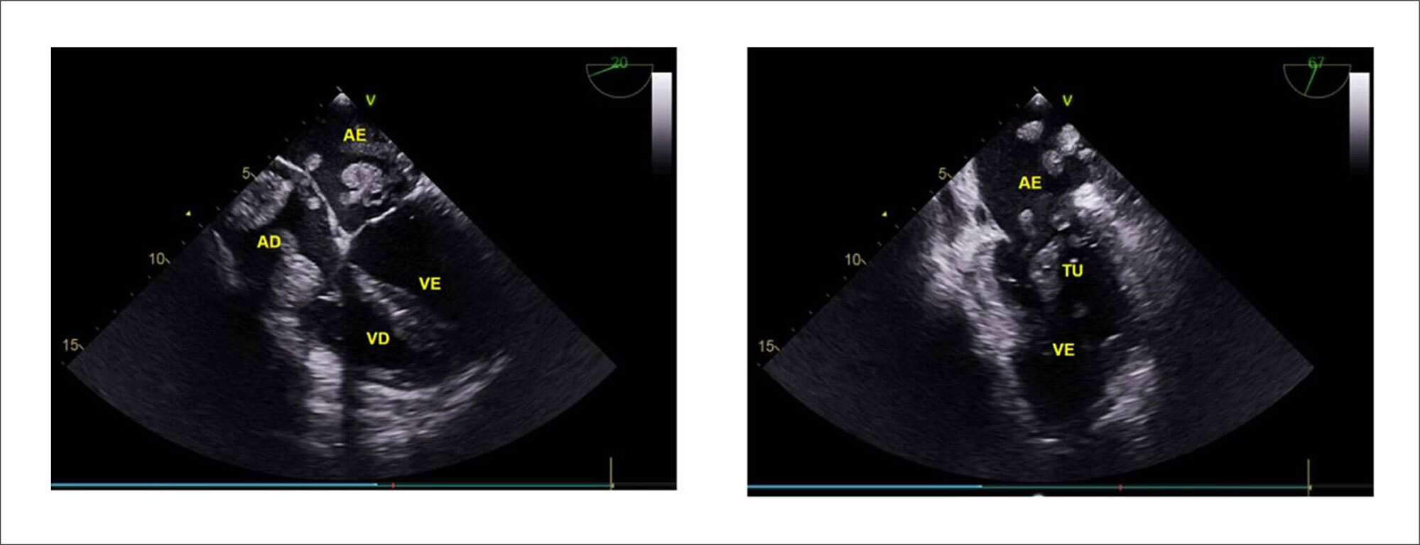 Cardiac Metastasis and Krukenberg Tumor: A Case Report - ABC Imaging