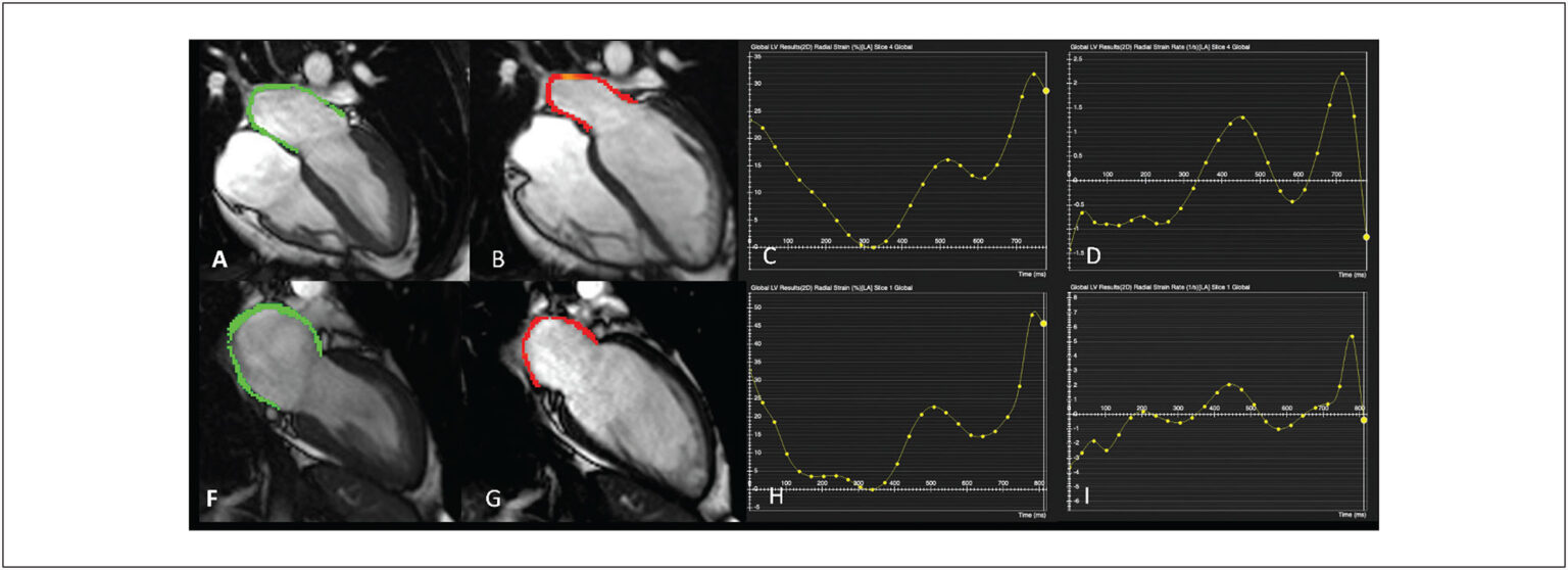 My Approach to Atrial Strain by Cardiac Magnetic Resonanc - ABC Imaging