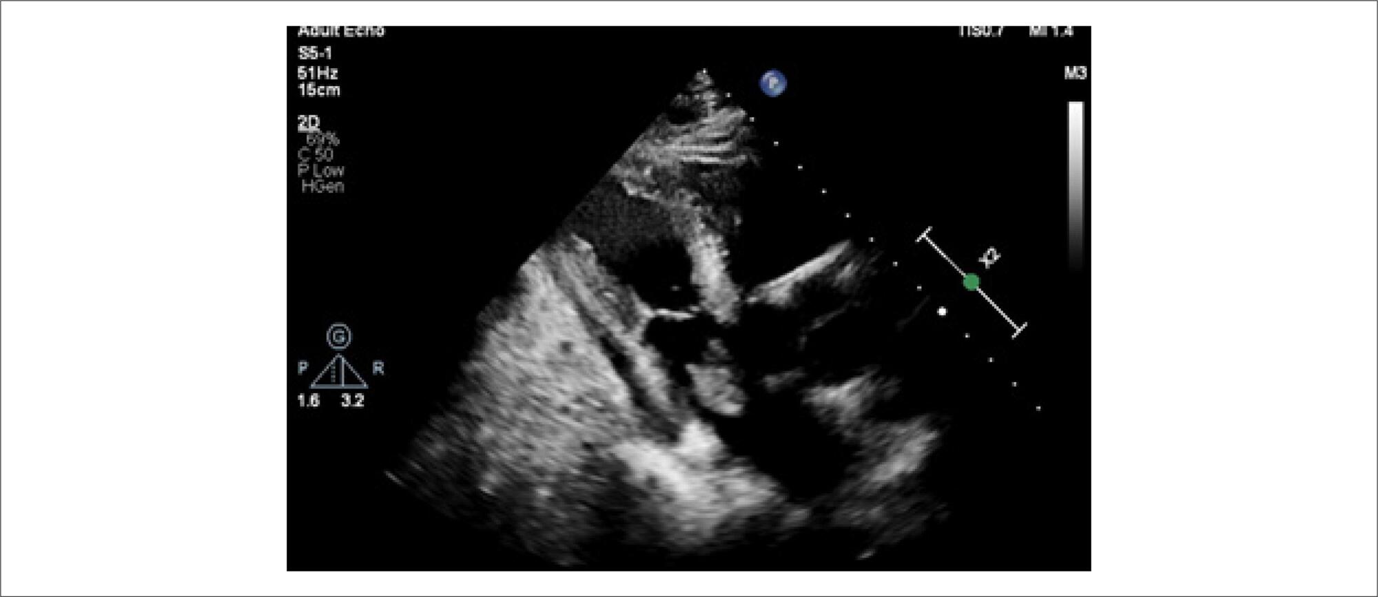Mixoma Atrial Como Causa Rara de Acidente Vascular Cerebral: Relato de ...