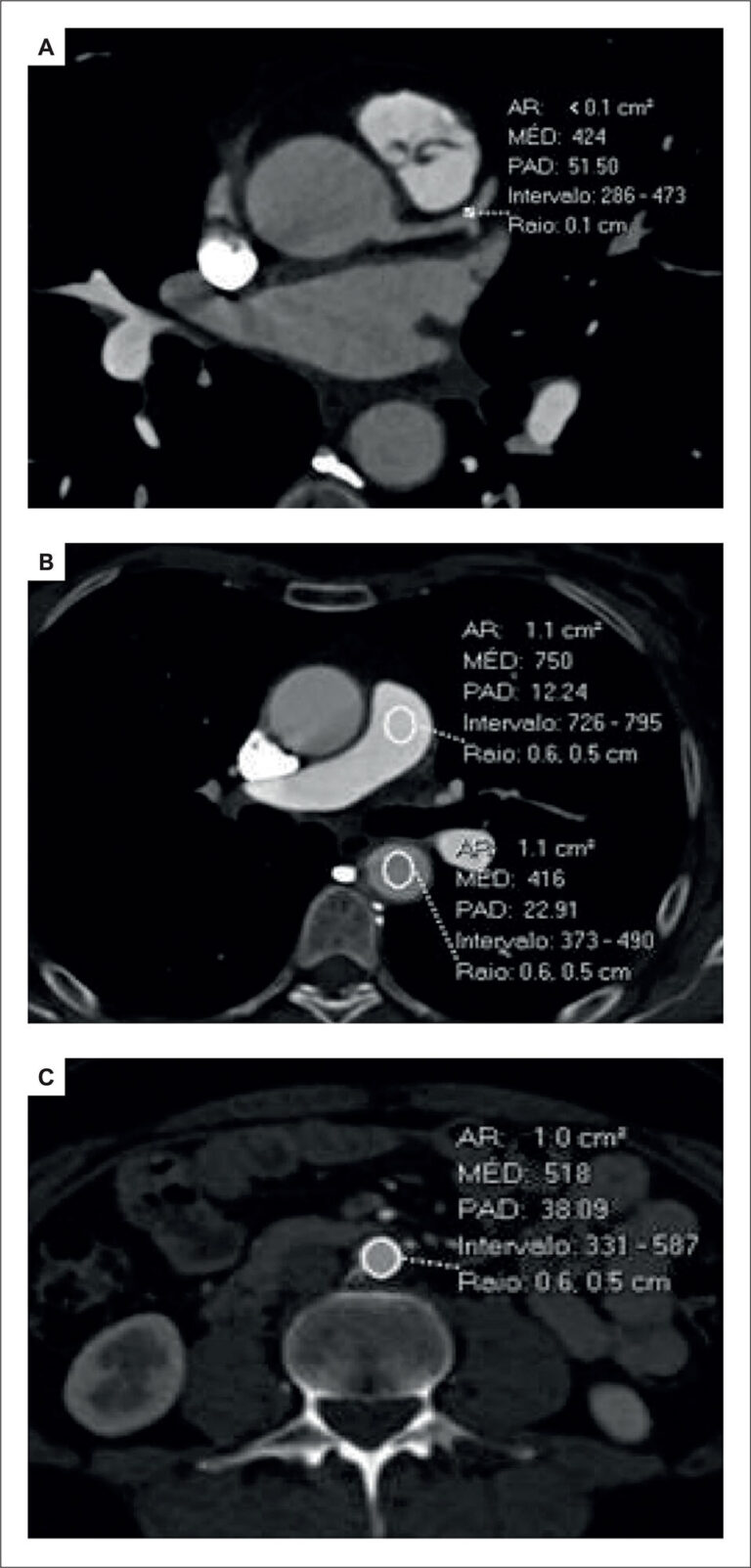 Conventional and Partially ECG-Gated Triple Rule-Out Computed ...
