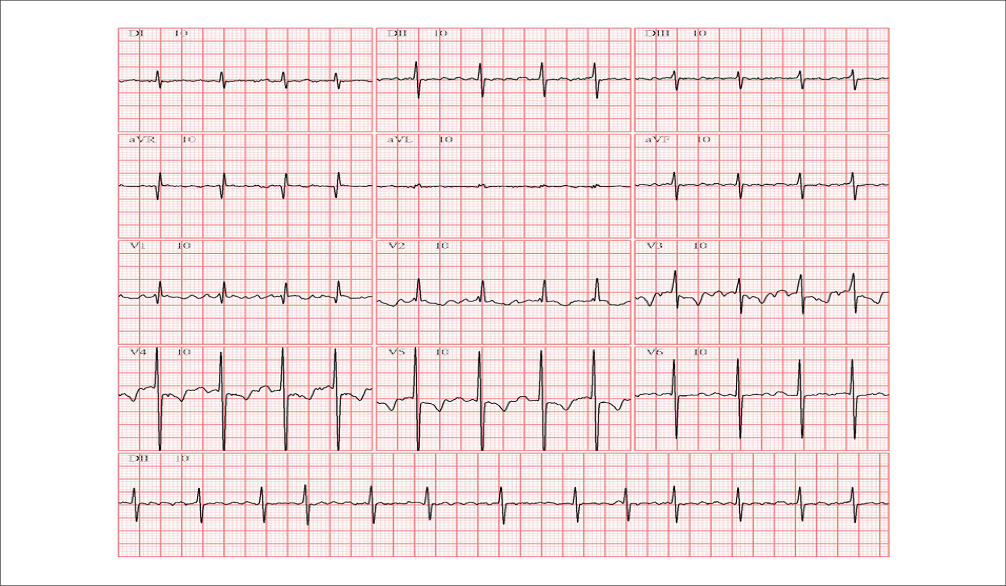 Desafios e Implicações do Defeito do Septo Atrioventricular Não ...