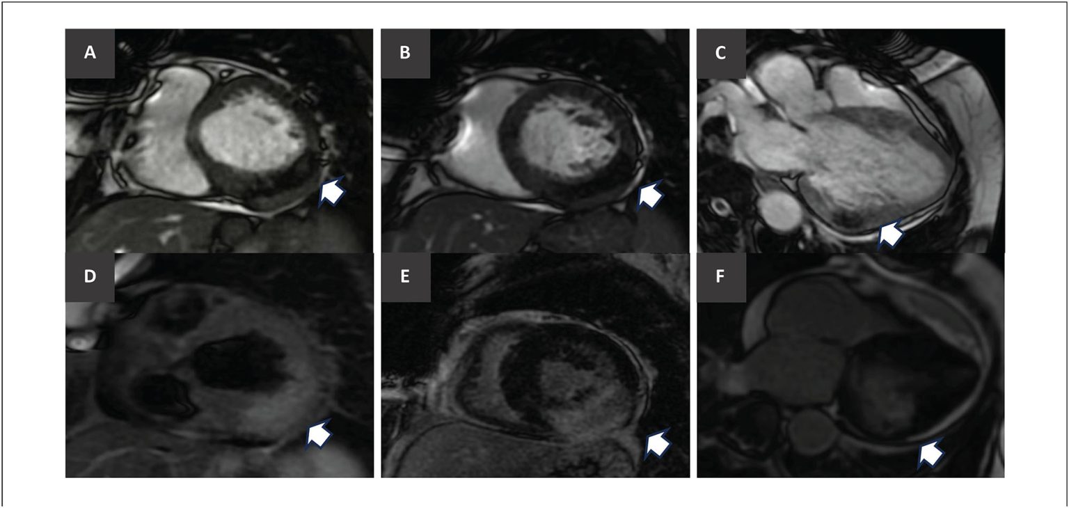 Intramyocardial Cardiac Tumor: A Case Report - ABC Imaging