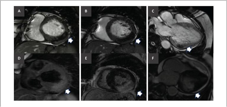 Intramyocardial Cardiac Tumor: A Case Report - ABC Imaging