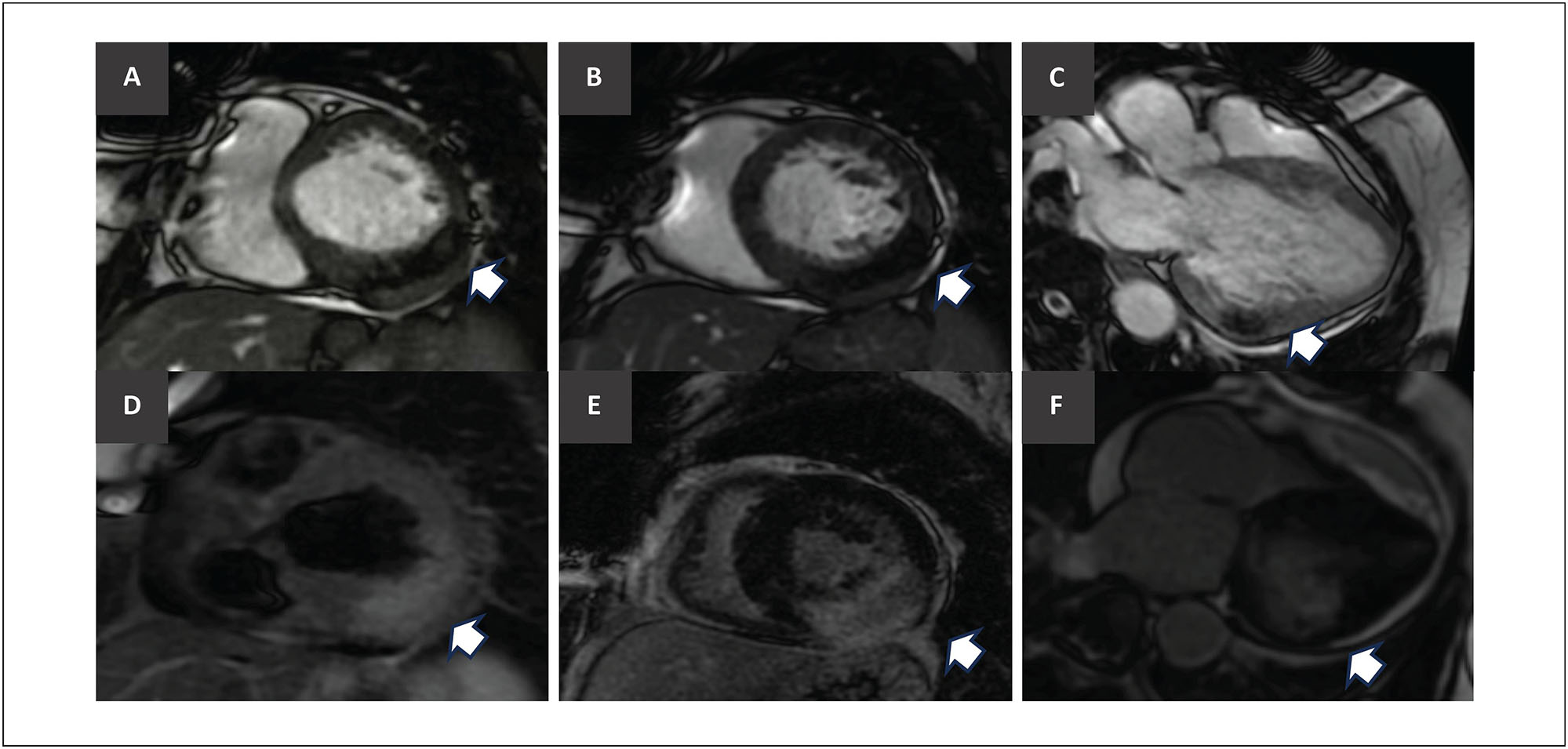 Tumor Cardíaco Intramiocárdico: Um Relato de Caso - ABC Imaging
