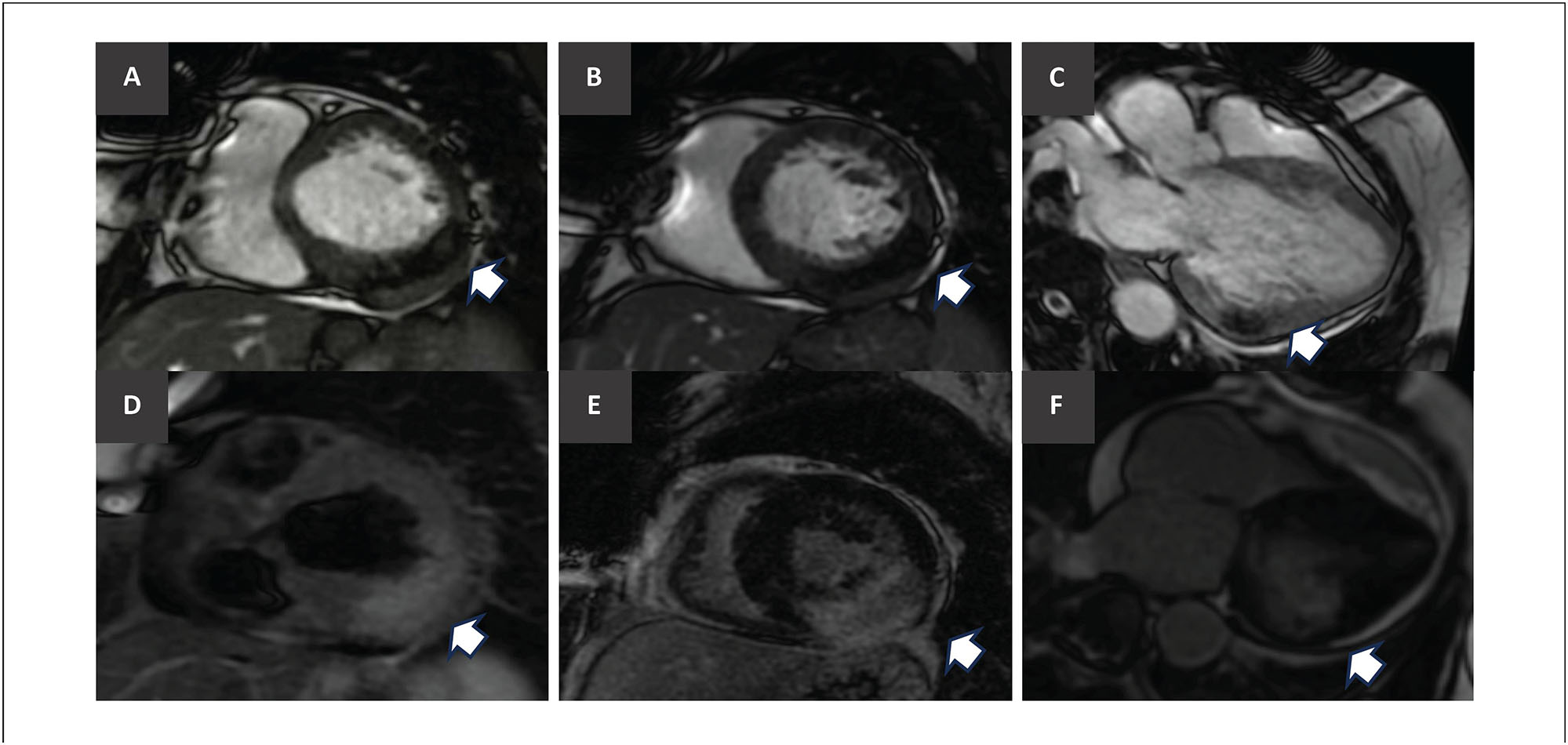 Intramyocardial Cardiac Tumor: A Case Report - ABC Imaging