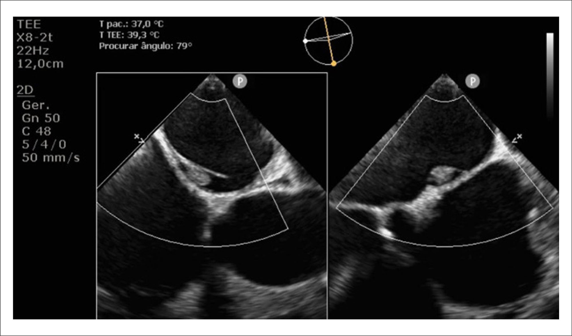 Left Atrial Septal Pouch Thrombosis Detected Before Electrical ...