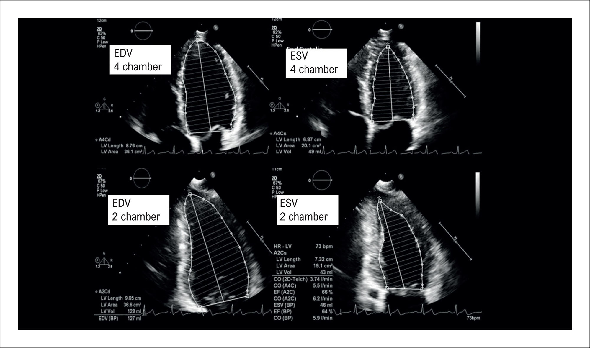 How I Assess Left Ventricular Systolic Function - ABC Imaging